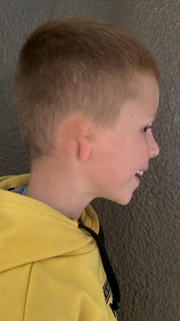 New ear gives boy (8) confidence to face bullies - LNN - Lowvelder